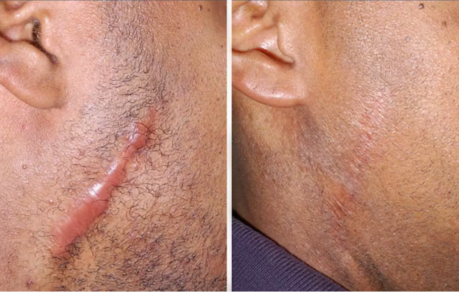 Laser Skin Therapy – Seraphim Beauty