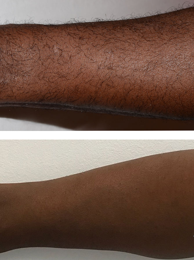 Laser Hair Removal — Reserve Your Spot – Seraphim Beauty & Skin Clinic