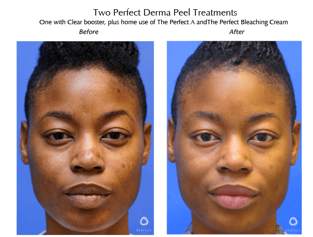 The Perfect Derma Peel – Seraphim Beauty